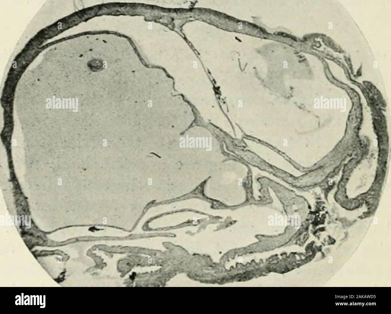Gynecological diagnosis and pathology . Fig. 54.—Uterus Laid Open ...