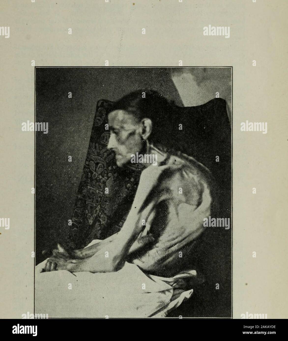 Maryland medical journal . PROGRESSIVE MUSCULAR ATROPHY—Garrett. 439 ...