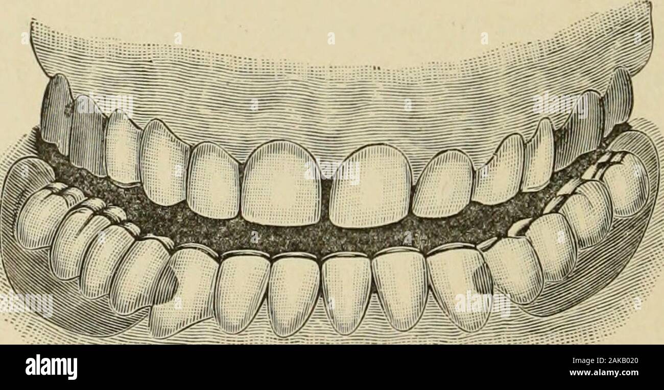 Gold inlays in teeth hi-res stock photography and images - Alamy