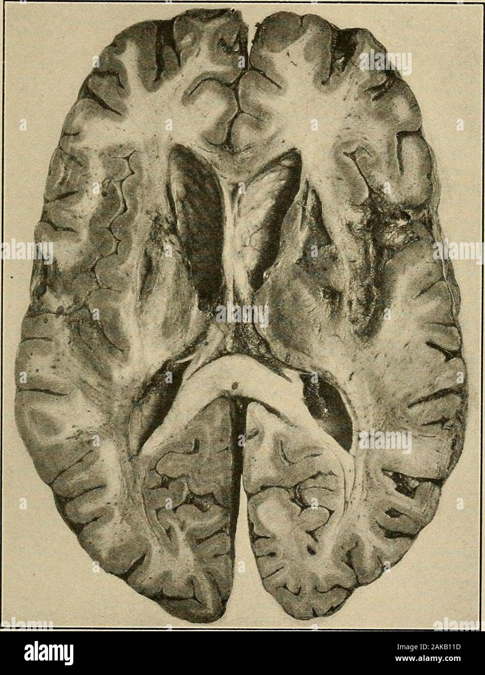 Tertiary syphilis l hi-res stock photography and images - Alamy Tertiary syphilis l hi-res stock photography and images - Alamy