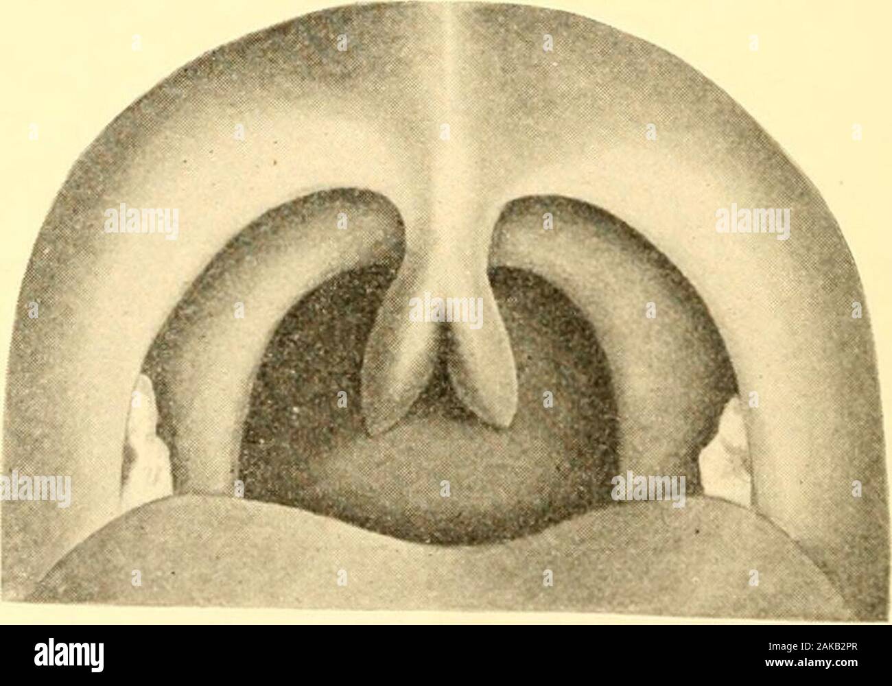 Bifid uvula hi-res stock photography and images - Alamy