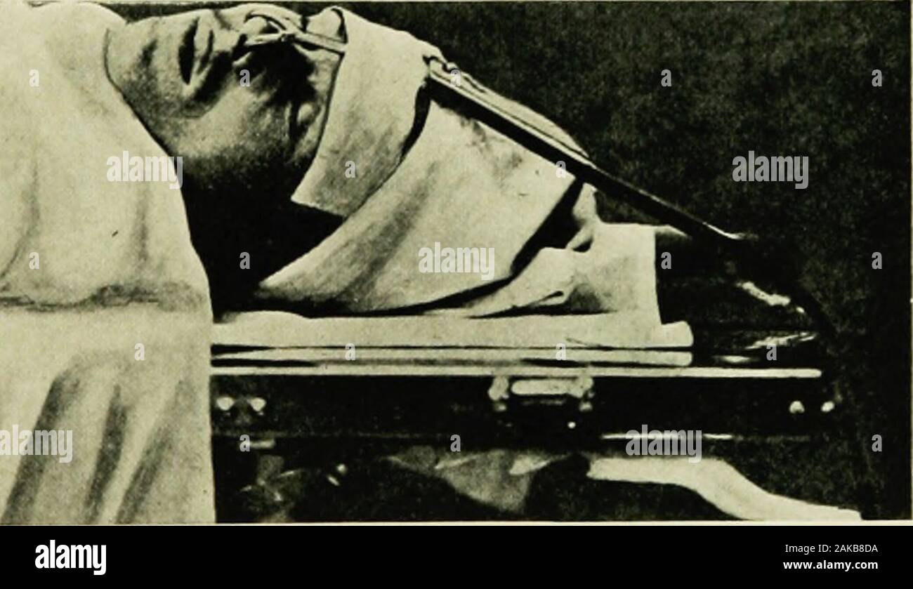 The art of anaesthesia . Fig. 85.—Intrapharyngeal anaesthesia, showing ...