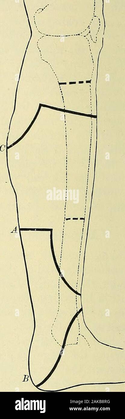 Leg amputation stump hi-res stock photography and images - Alamy