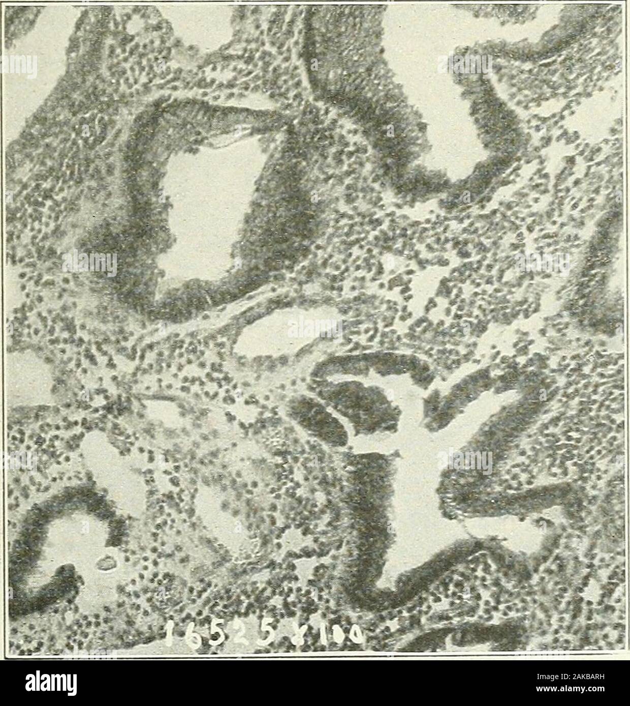 Cancer of the stomach; a clinical study of 921 operatively and ...