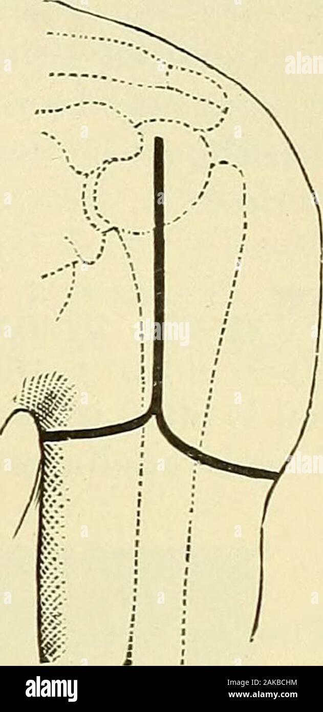 Surgery shoulder incision hi-res stock photography and images - Alamy