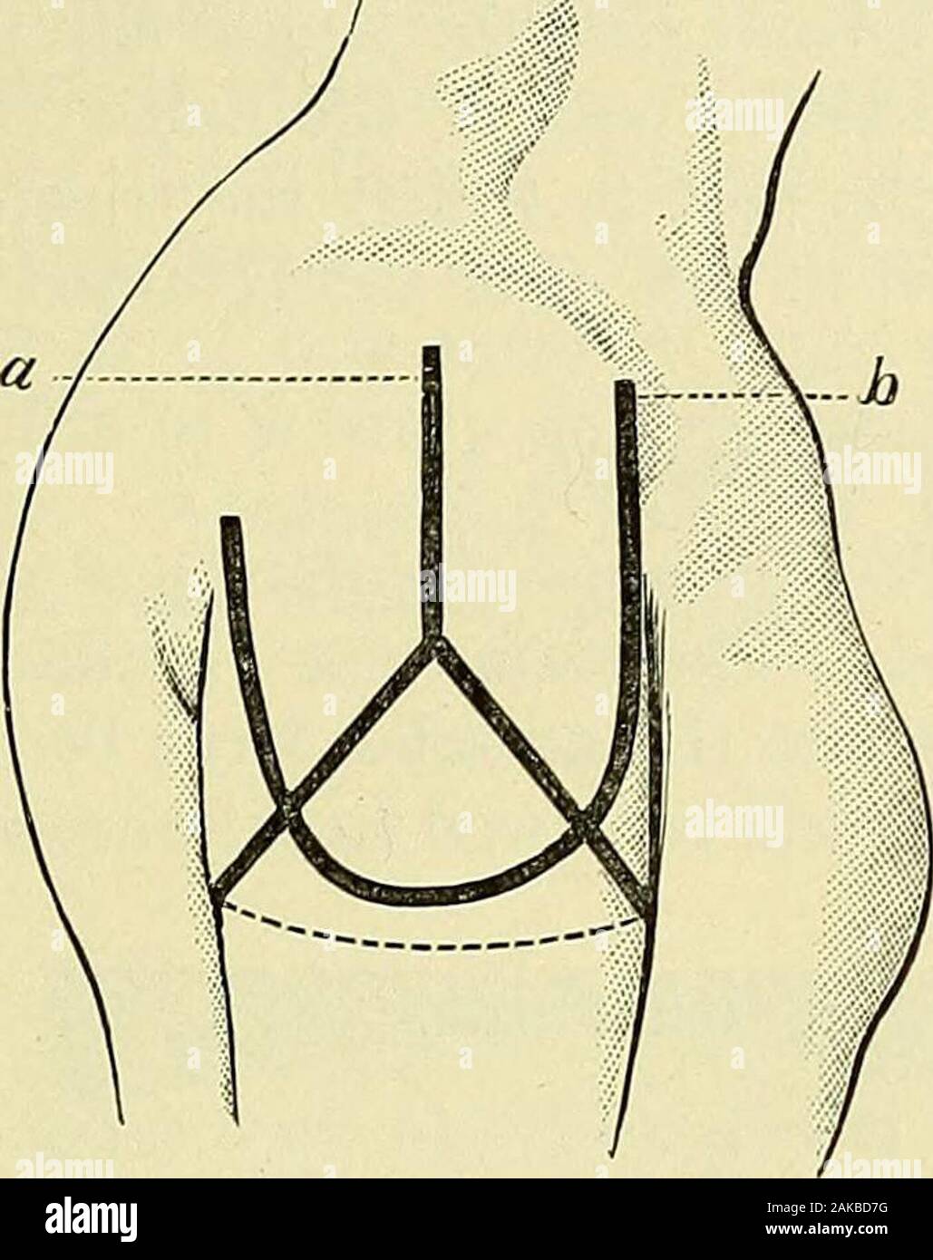 Surgery shoulder incision hi-res stock photography and images - Alamy