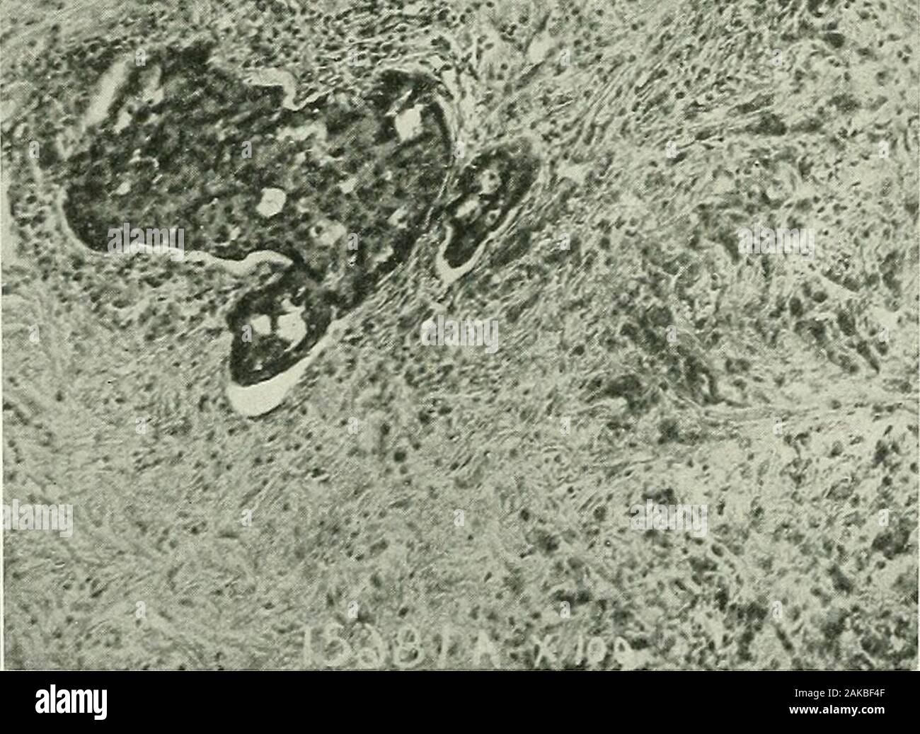 Cancer of the stomach; a clinical study of 921 operatively and ...