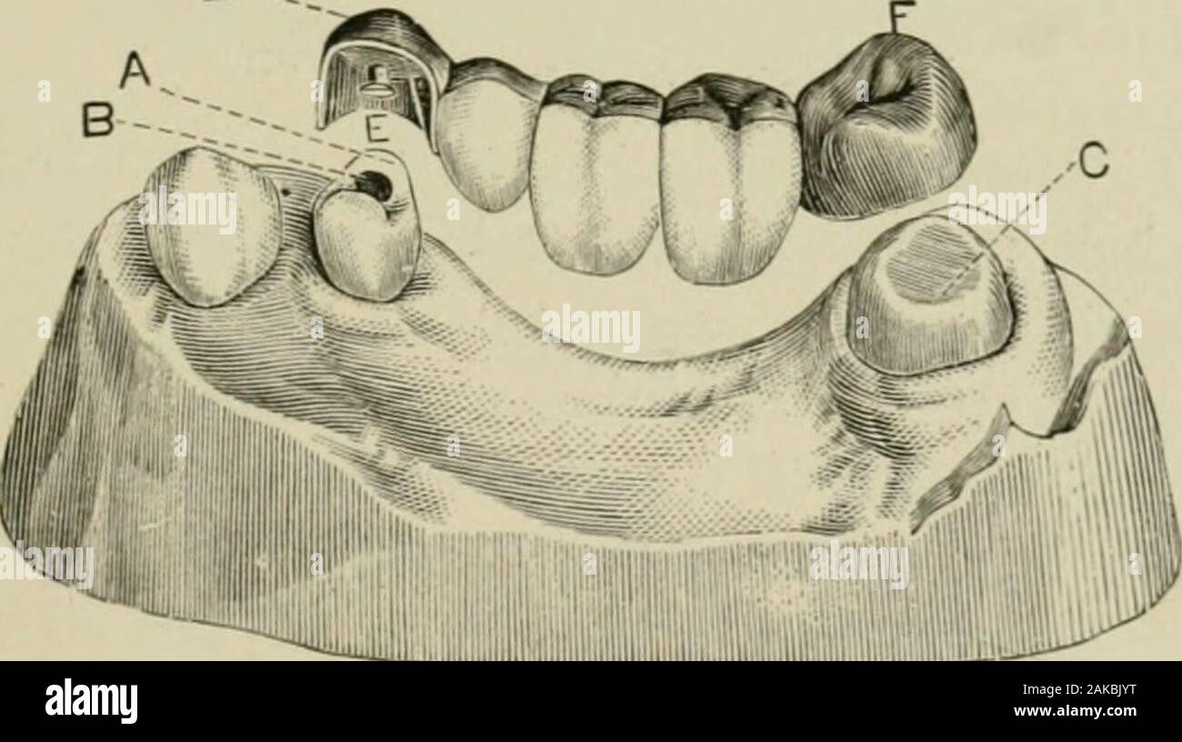 Gold tooth cap hi-res stock photography and images - Alamy