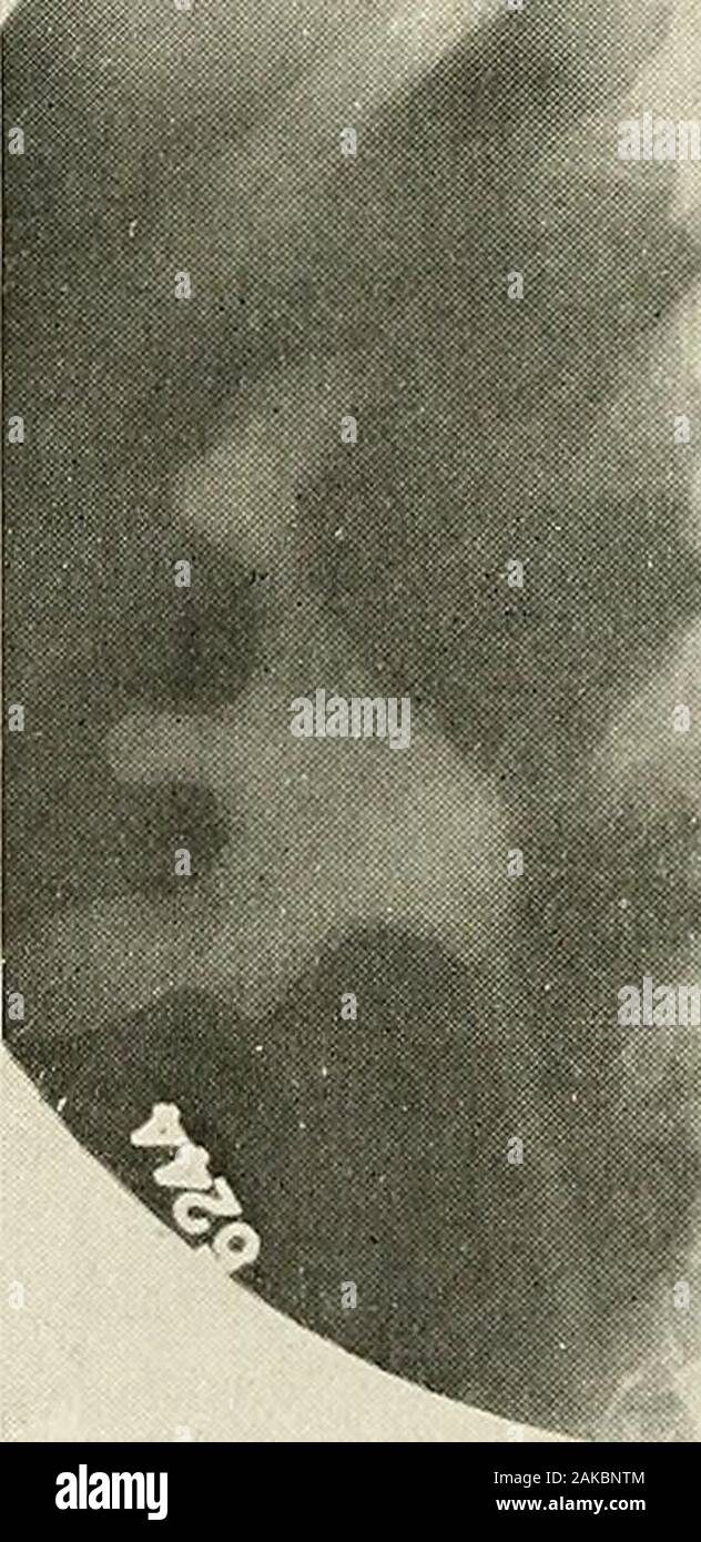 Pyelography (pyelo-ureterography) a study of the normal and pathologic ...