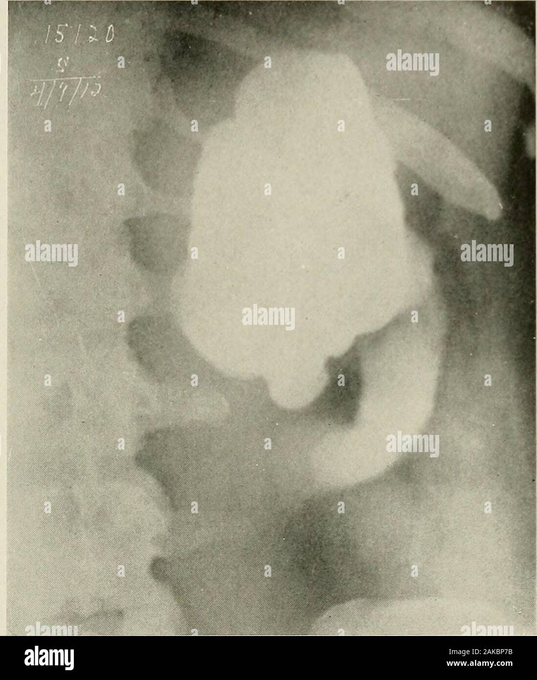 Pyelography (pyelo-ureterography) a study of the normal and pathologic ...