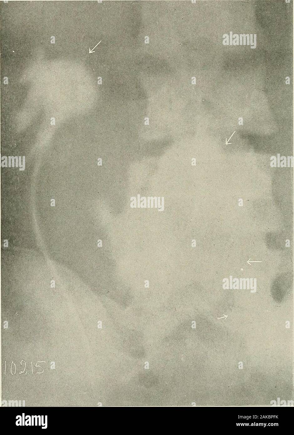 Pyelography (pyelo-ureterography) a study of the normal and pathologic ...