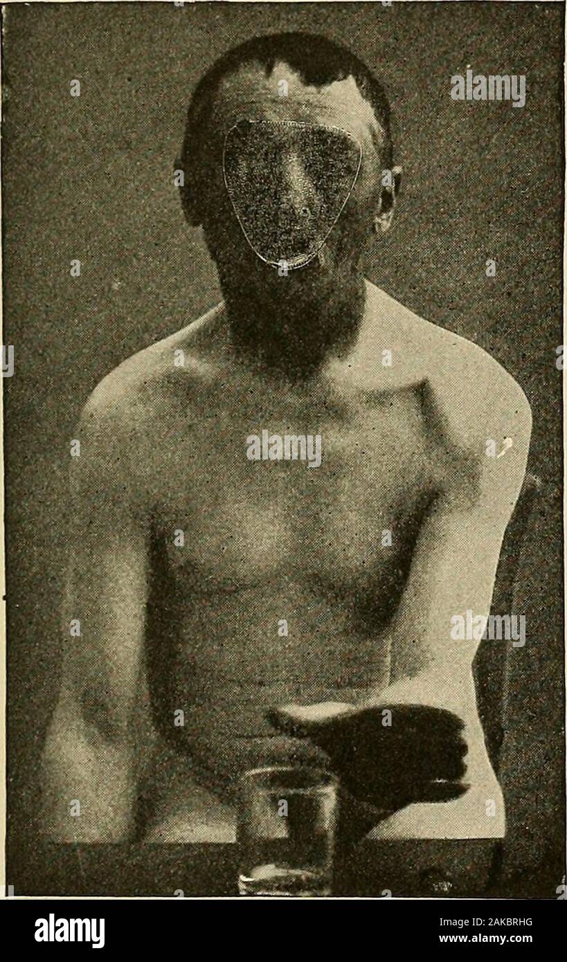 The bends disease hi-res stock photography and images - Alamy