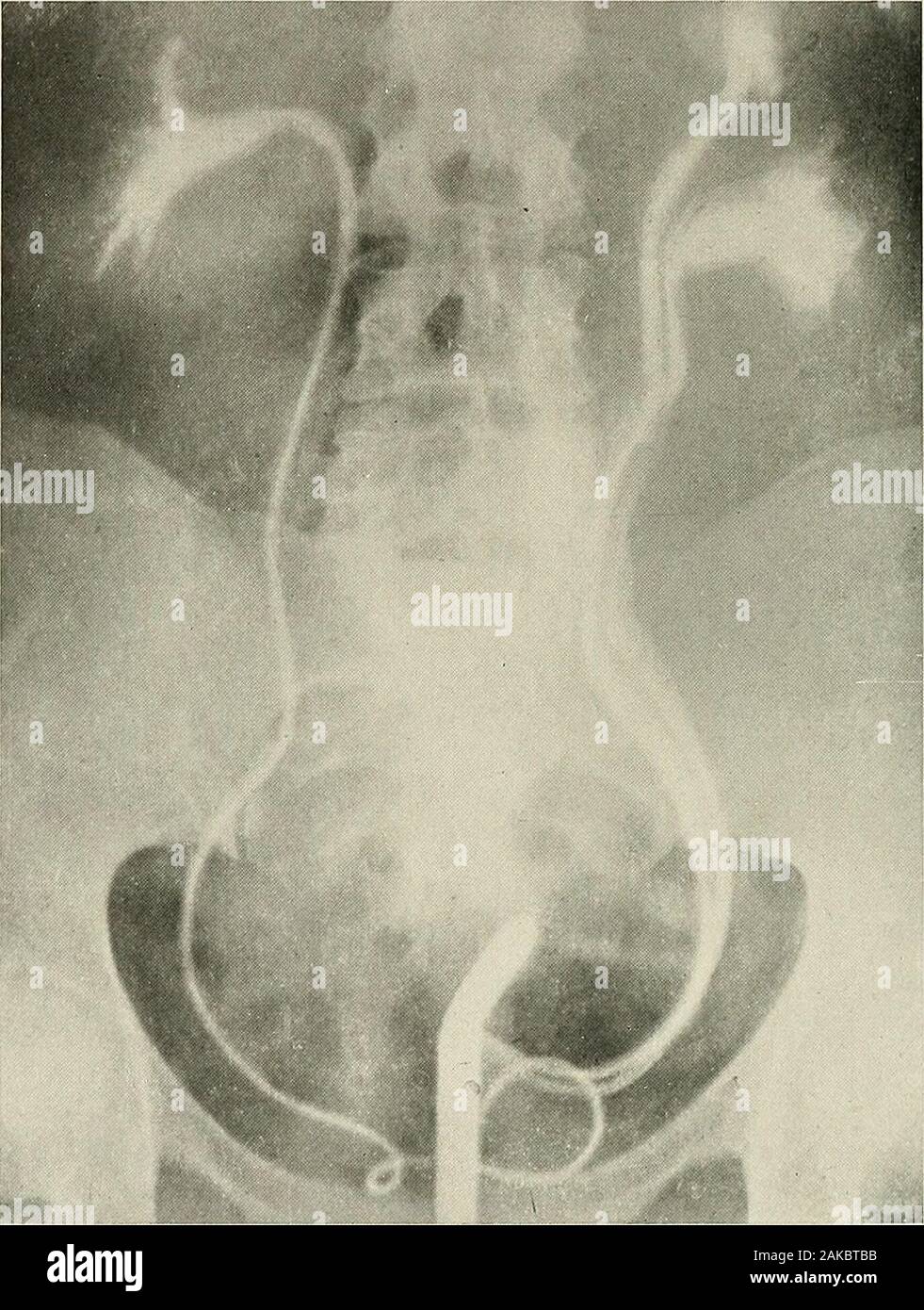 Pyelography (pyelo-ureterography) a study of the normal and pathologic ...