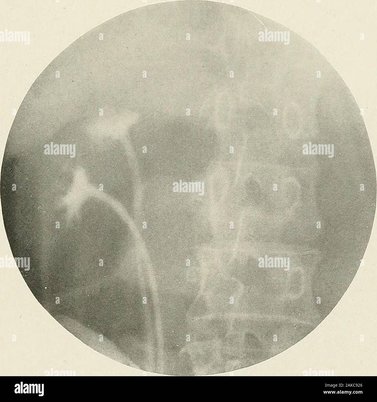 Pyelography (pyelo-ureterography) a study of the normal and pathologic ...