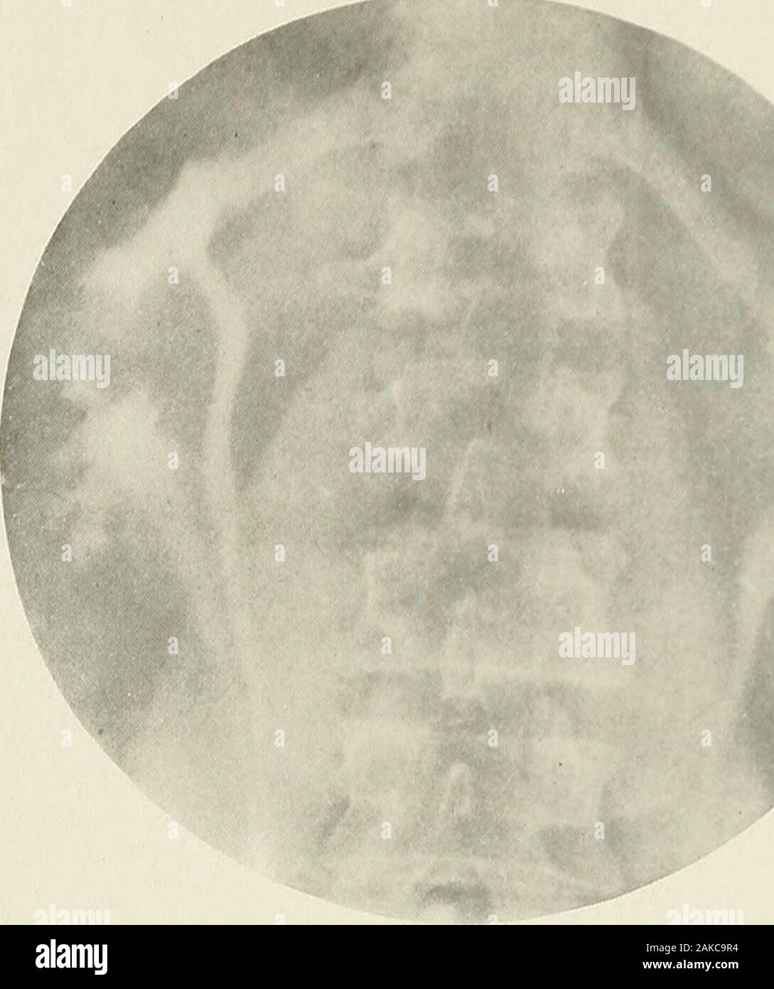 Pyelography (pyelo-ureterography) a study of the normal and pathologic ...