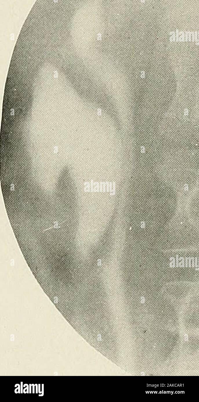 Pyelography (pyelo-ureterography) a study of the normal and pathologic ...