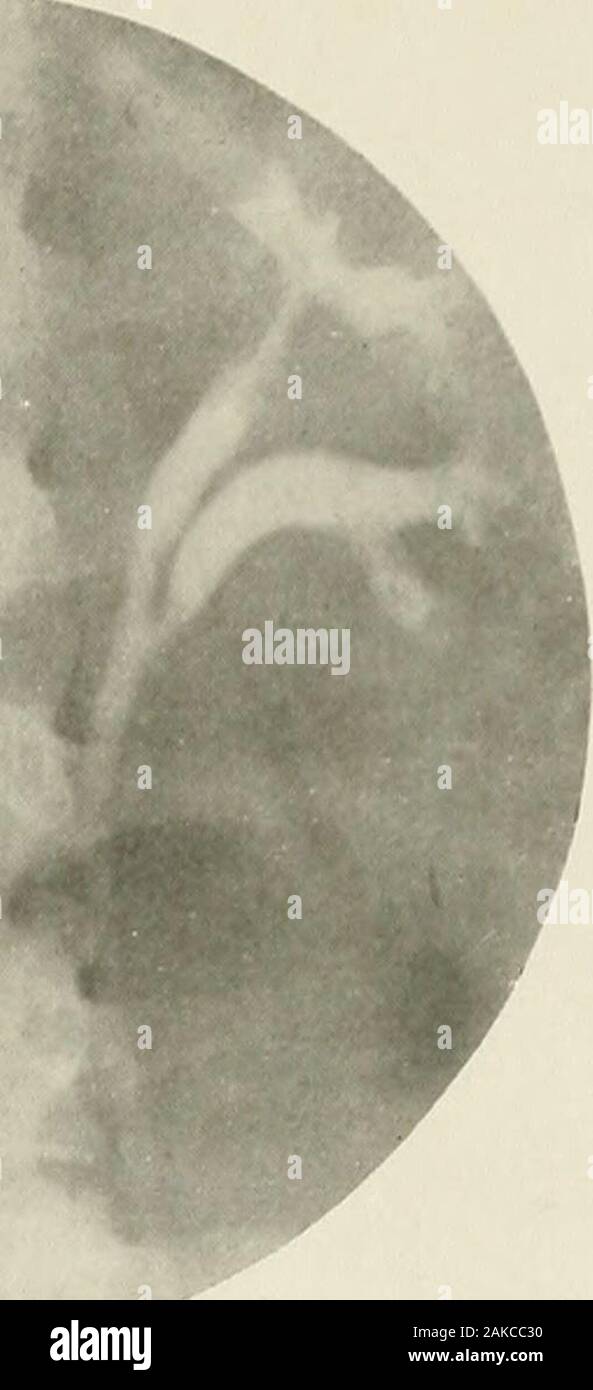 Pyelography (pyelo-ureterography) a study of the normal and pathologic ...