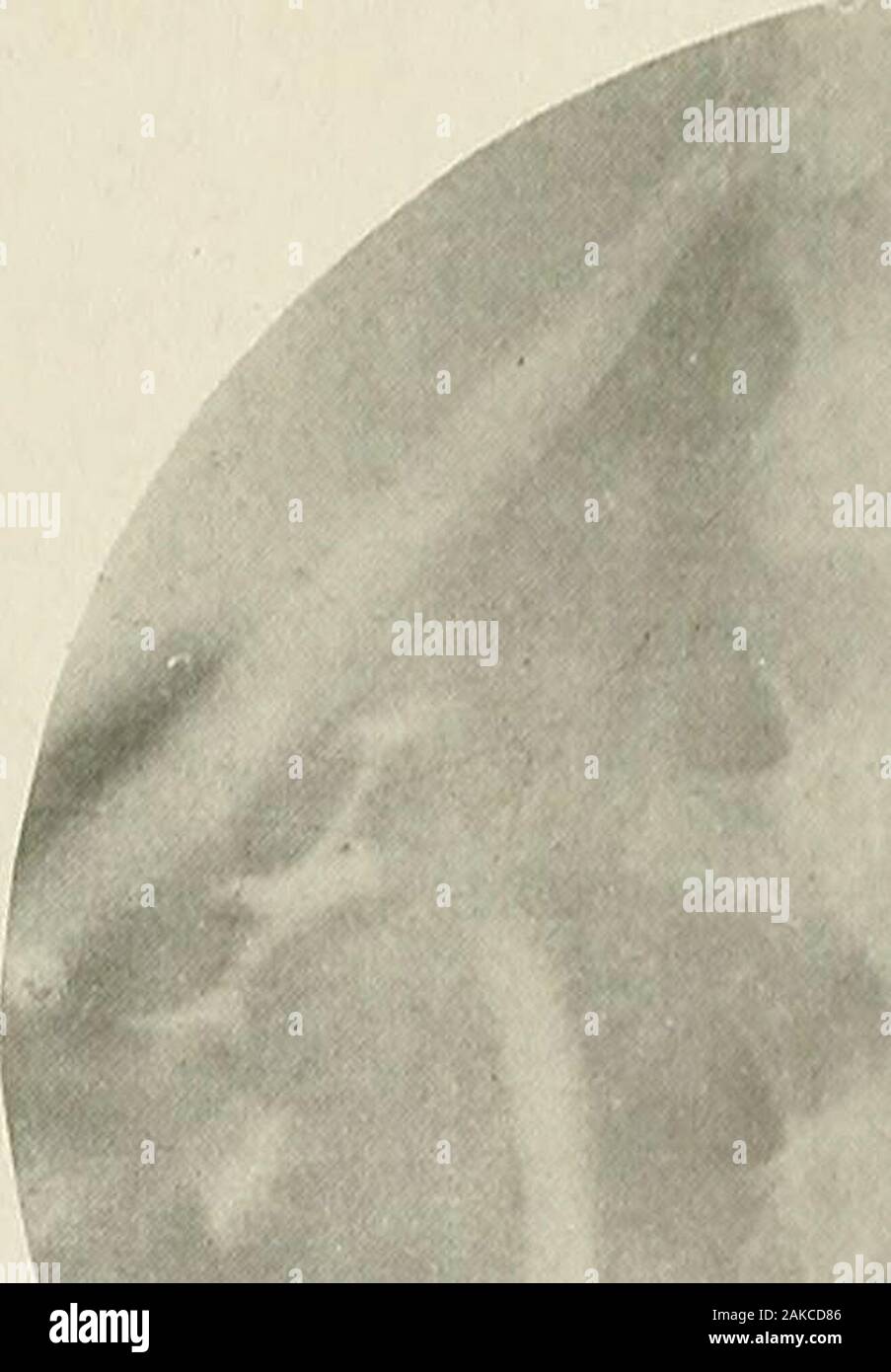 Pyelography (pyelo-ureterography) a study of the normal and pathologic ...