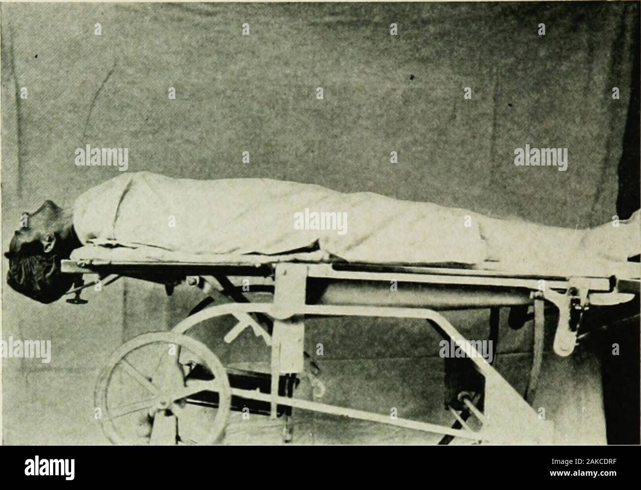 The art of anaesthesia . Fig. 35.—Ordinary neck position for glands of ...
