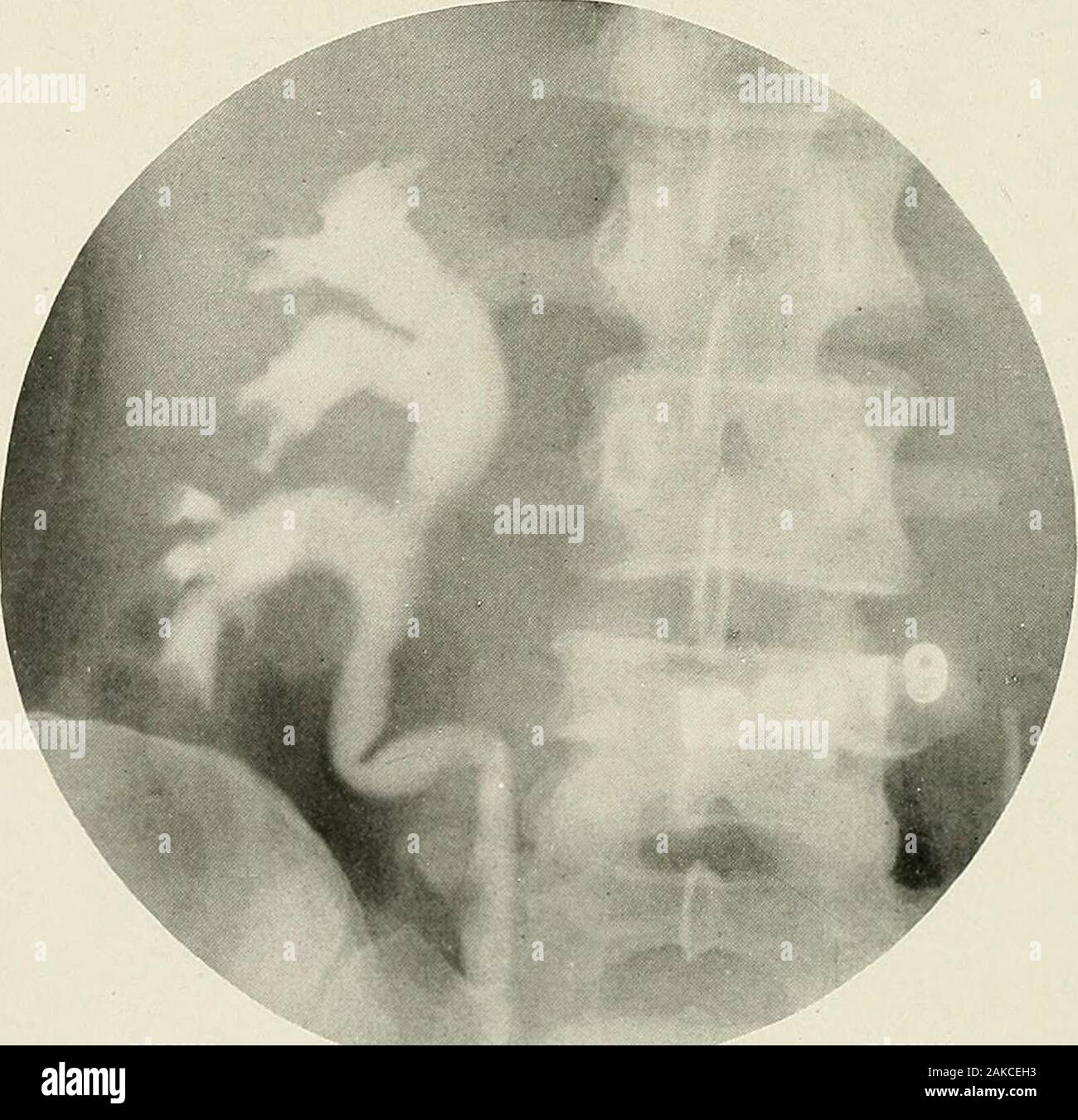 Renal Calyces Stock Photos & Renal Calyces Stock Images - Alamy