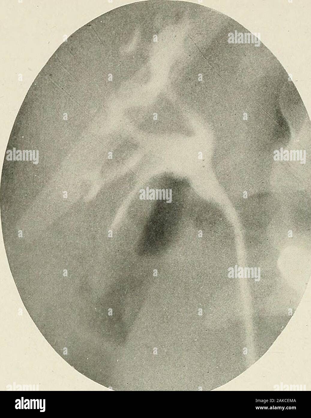 Renal calyces hi-res stock photography and images - Alamy