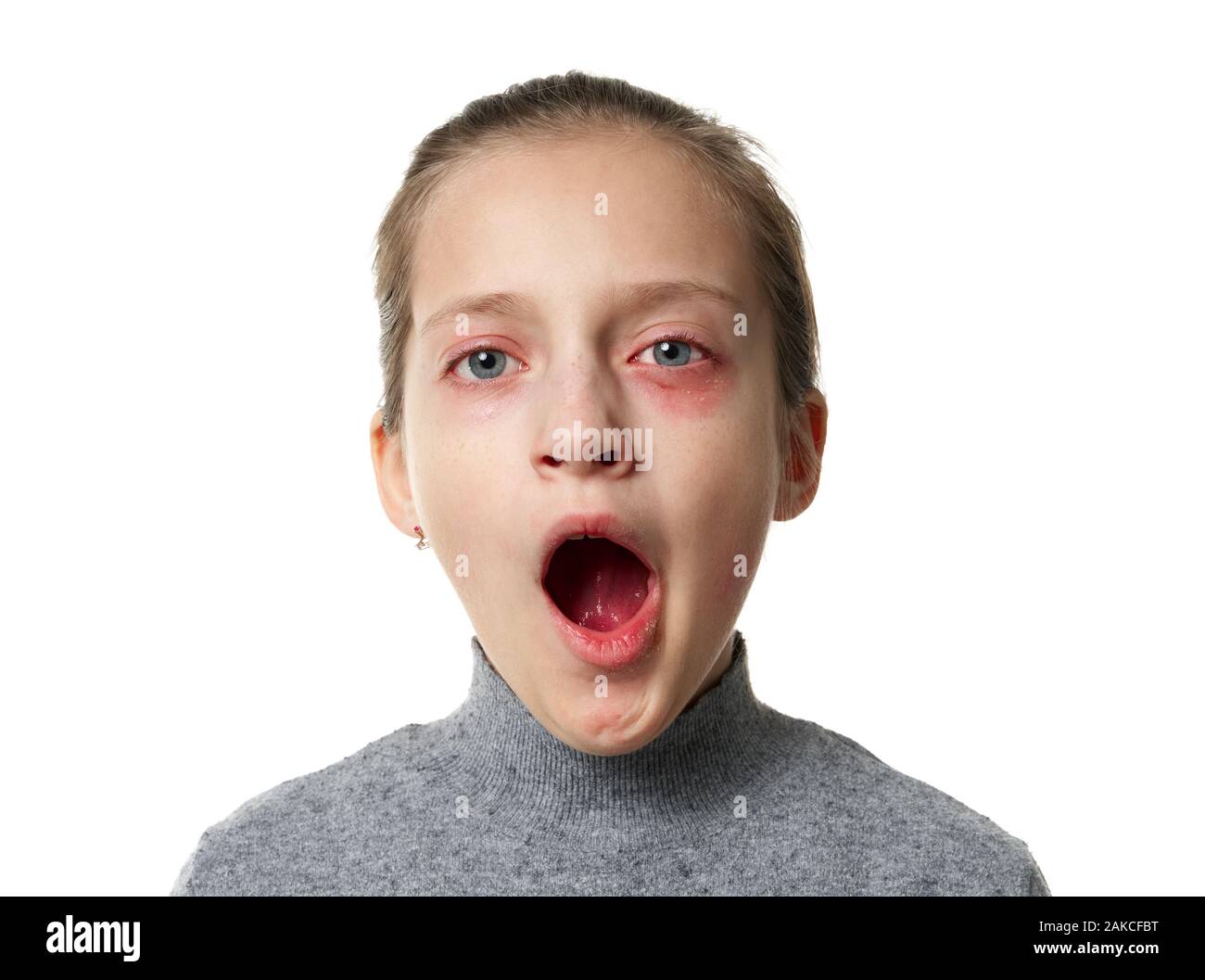 Allergic reaction, skin rash, close view portrait of a girl's face ...