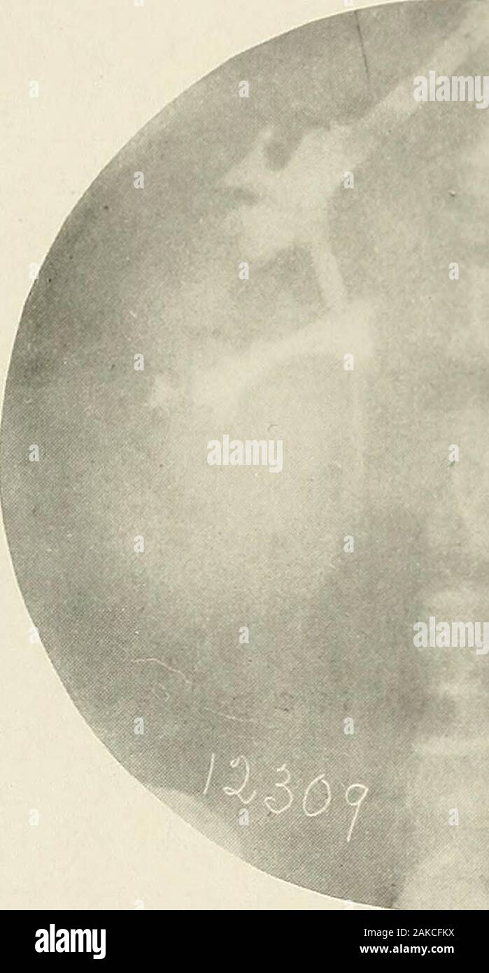 Pyelography (pyelo-ureterography) a study of the normal and pathologic ...