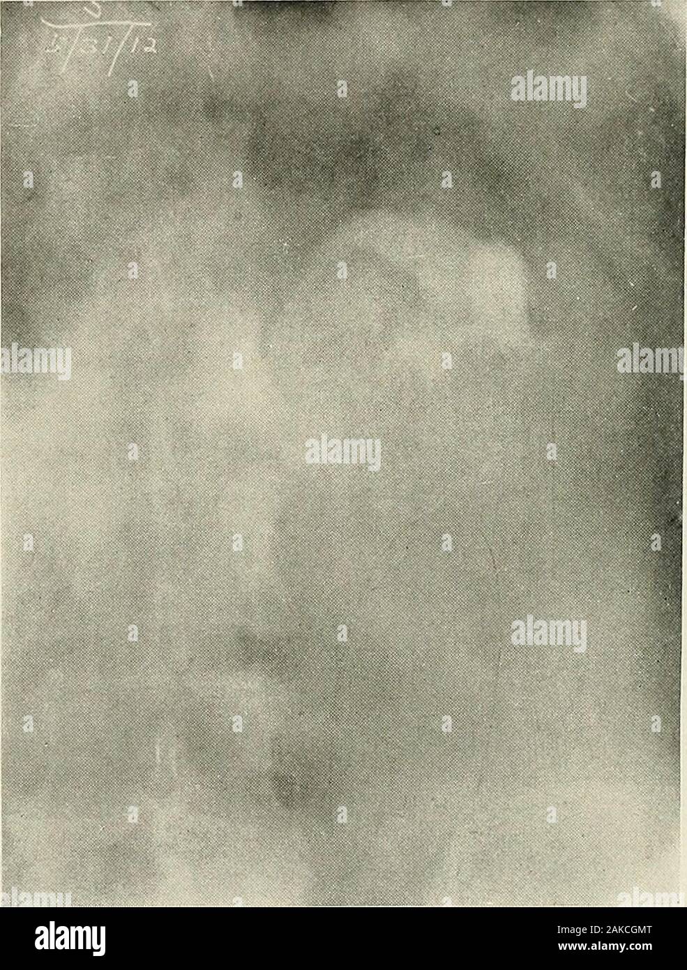 Pyelography (pyelo-ureterography) a study of the normal and pathologic ...