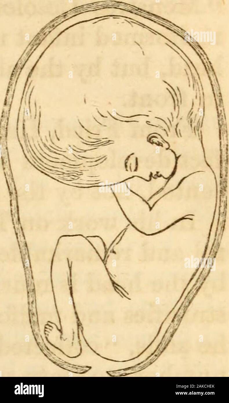 Hydrocephalus in infant hi-res stock photography and images - Alamy