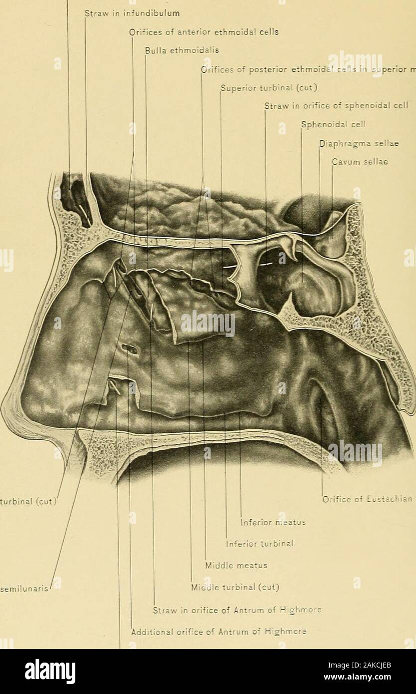 Ethmoidal Infundibulum CT Sinus
