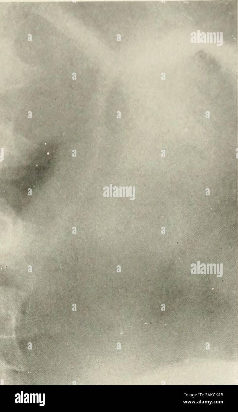Pyelography (pyelo-ureterography) a study of the normal and pathologic ...