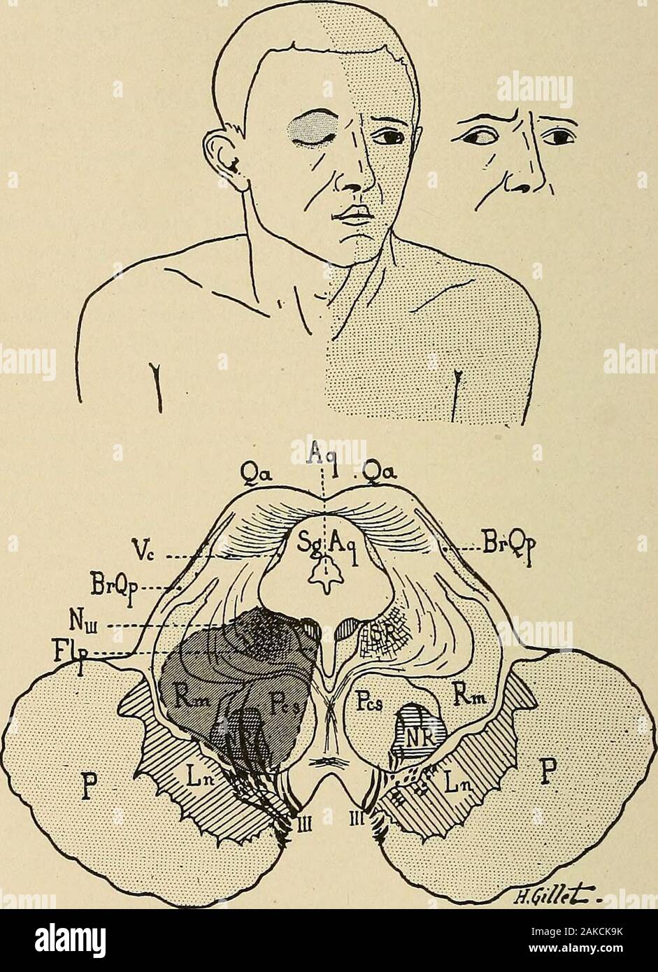Superior vermis of the cerebellum hi-res stock photography and images ...