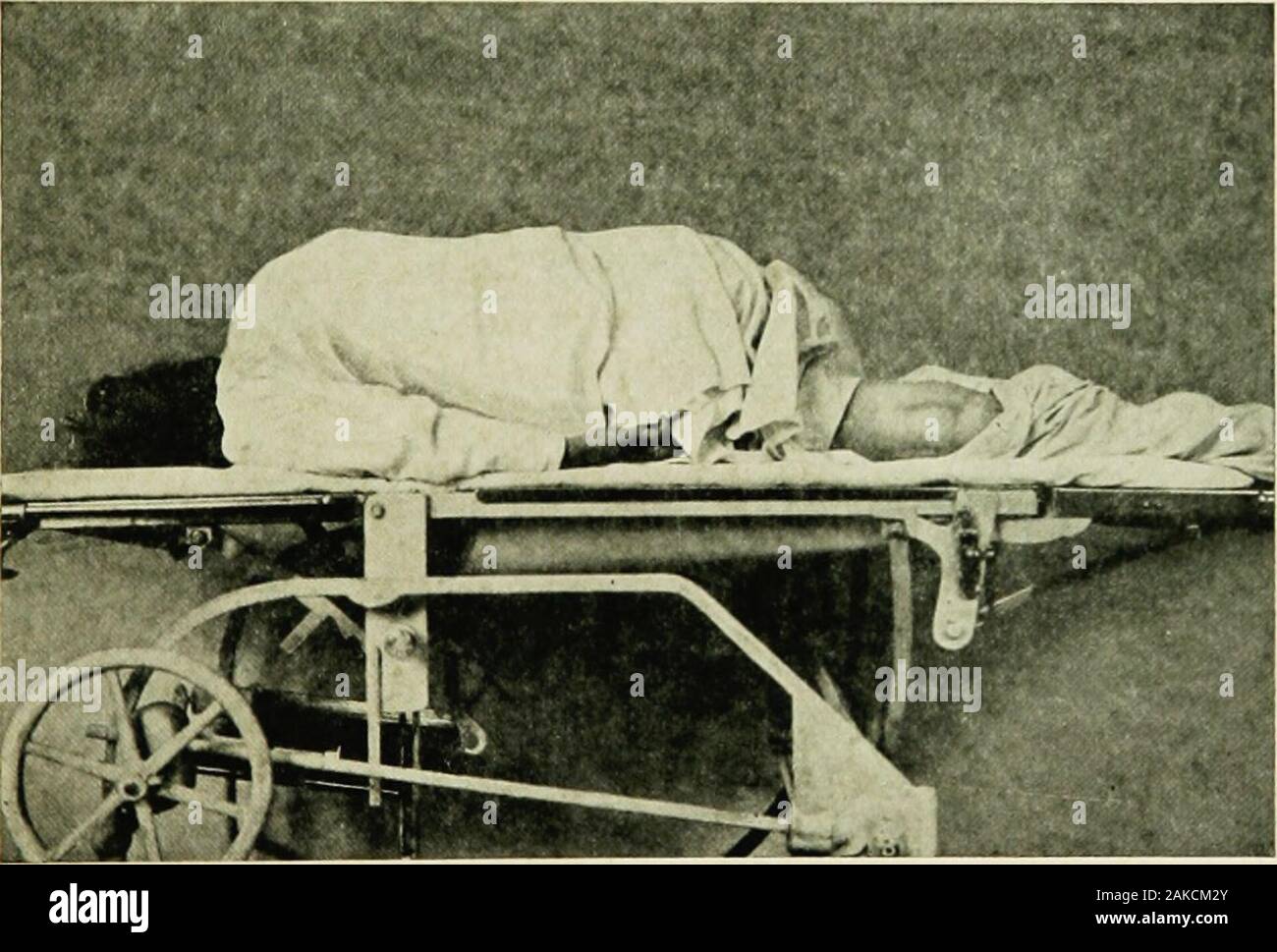 The art of anaesthesia . Fig. 20.—Patient in Trendelenburg position ...