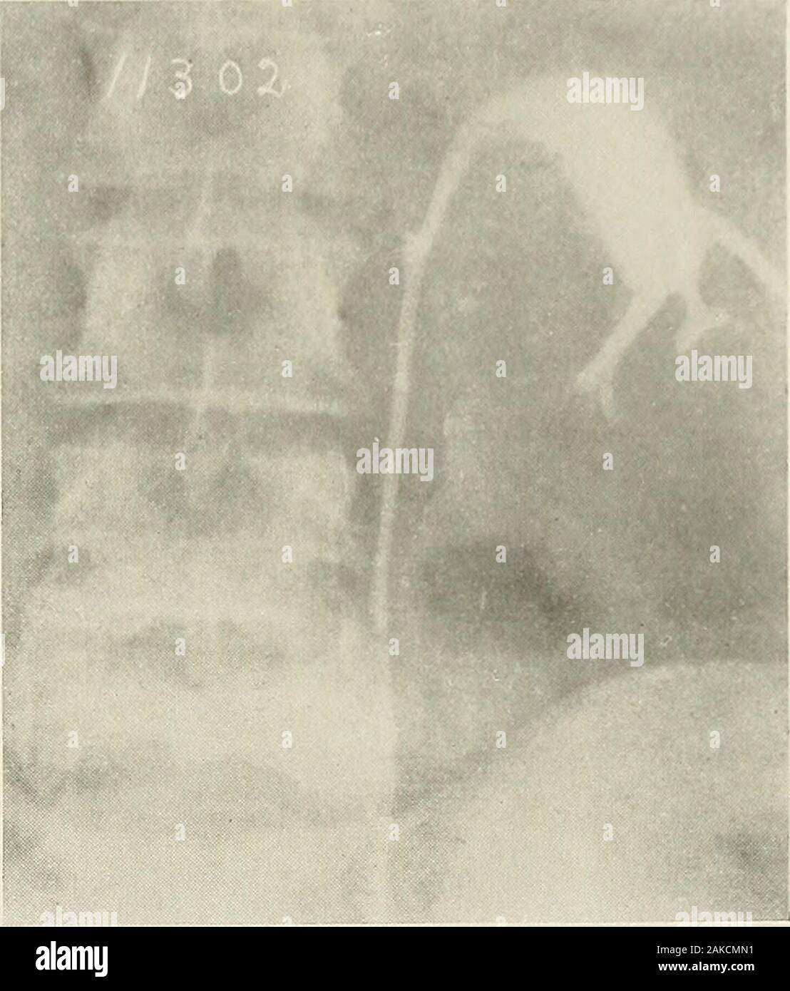 Pyelography (pyelo-ureterography) a study of the normal and pathologic ...