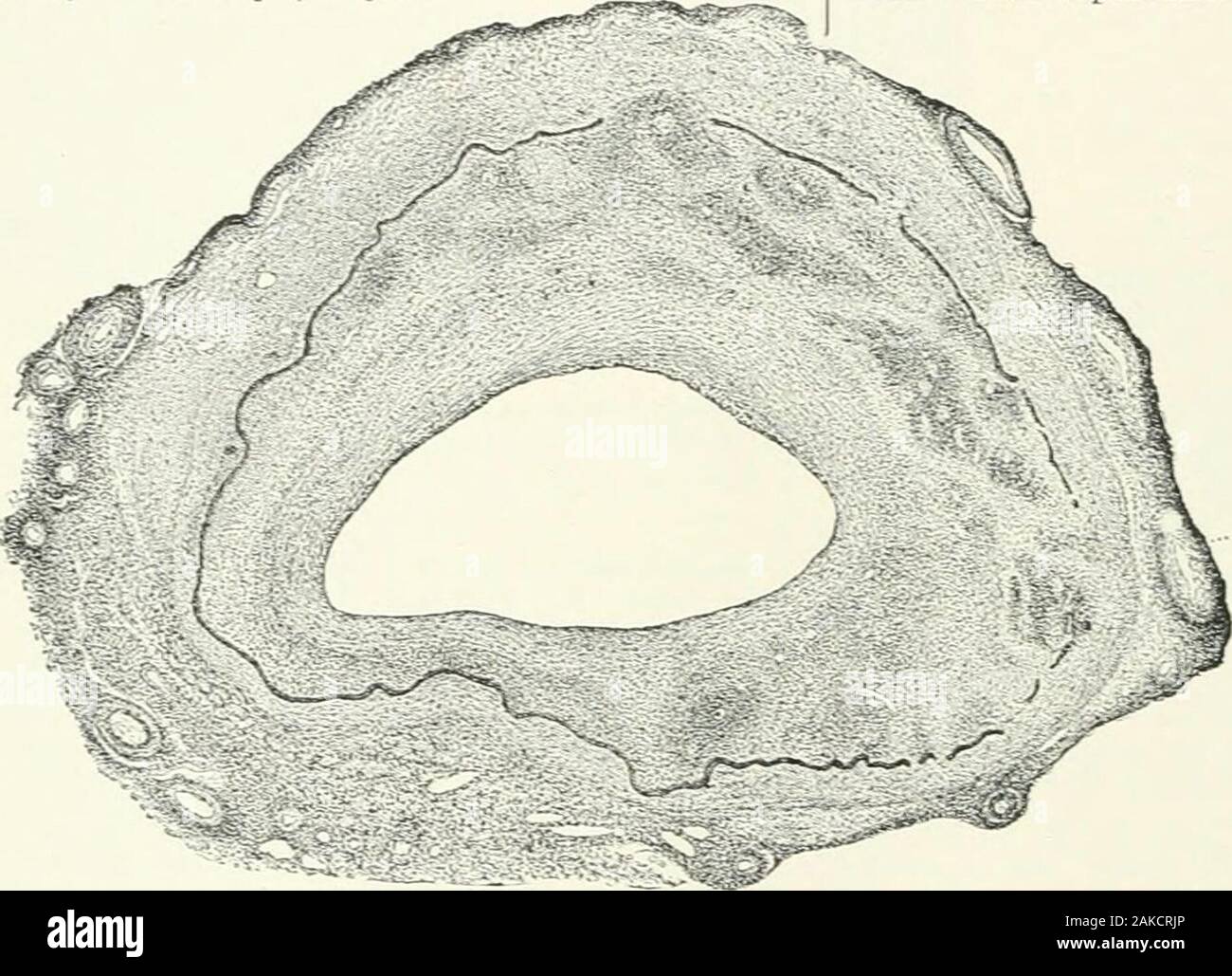 Endarteritis hi-res stock photography and images - Alamy