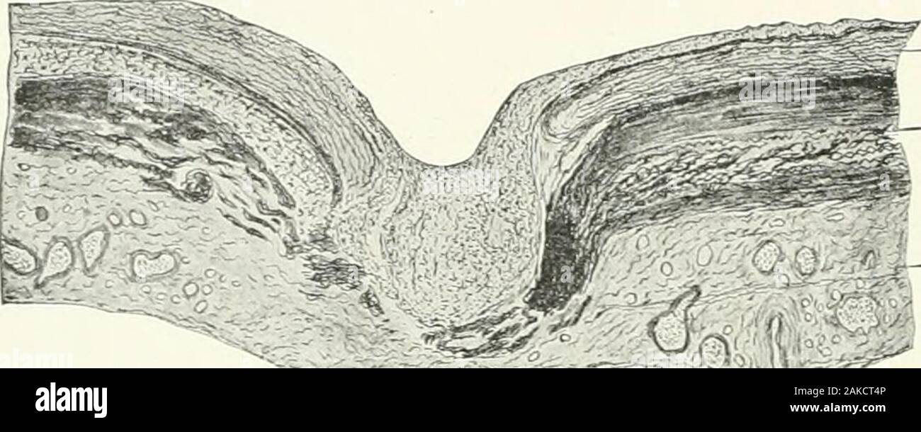 Endarteritis hi-res stock photography and images - Alamy