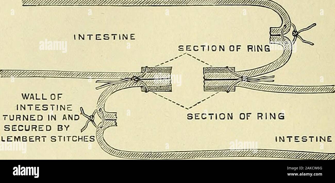 Side to side anastomosis hi-res stock photography and images - Alamy