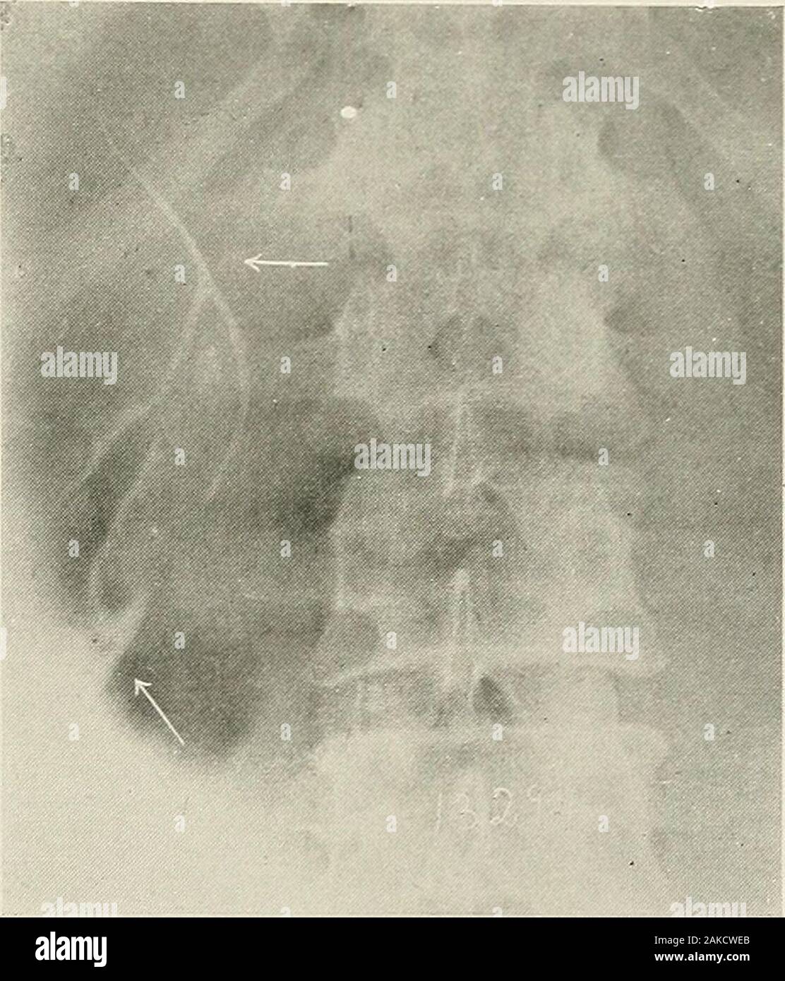 Pyelography (pyelo-ureterography) a study of the normal and pathologic ...