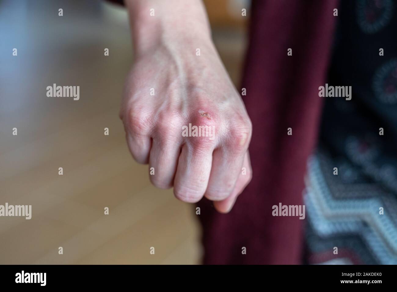 Burn scar hand hi-res stock photography and images - Alamy