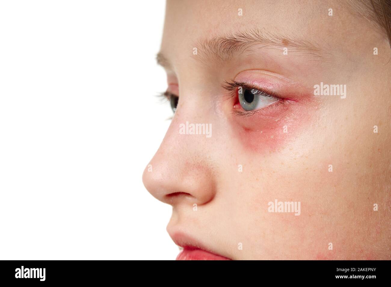 Allergic reaction, skin rash, close view portrait of a girl's face ...