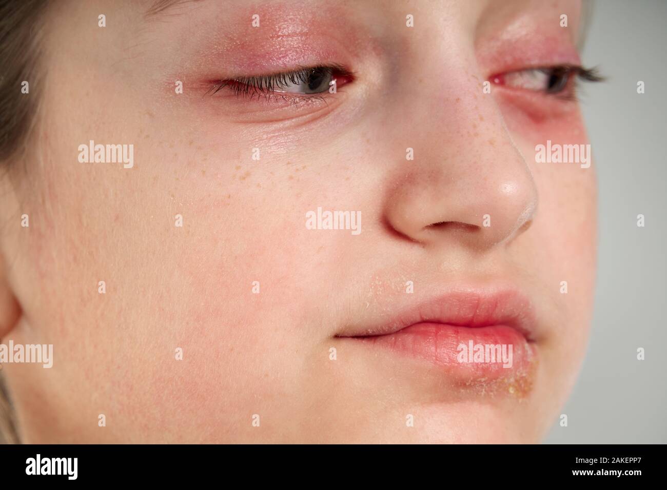 Allergic reaction, skin rash, close view portrait of a girl's face ...
