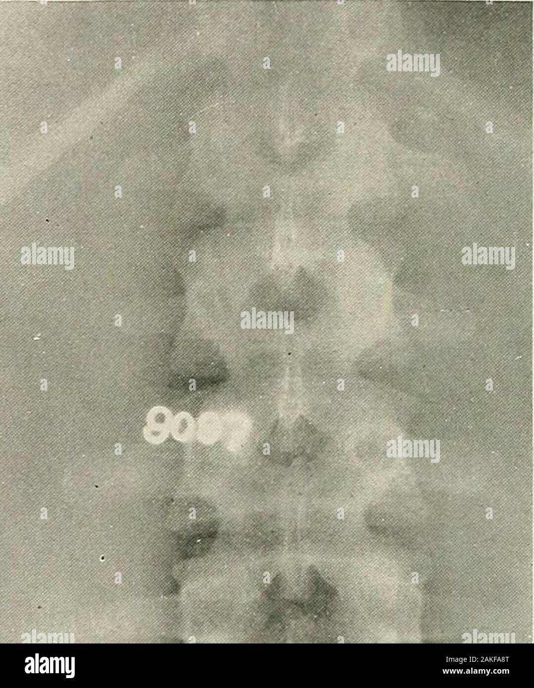 Pyelography (pyelo-ureterography) a study of the normal and pathologic ...