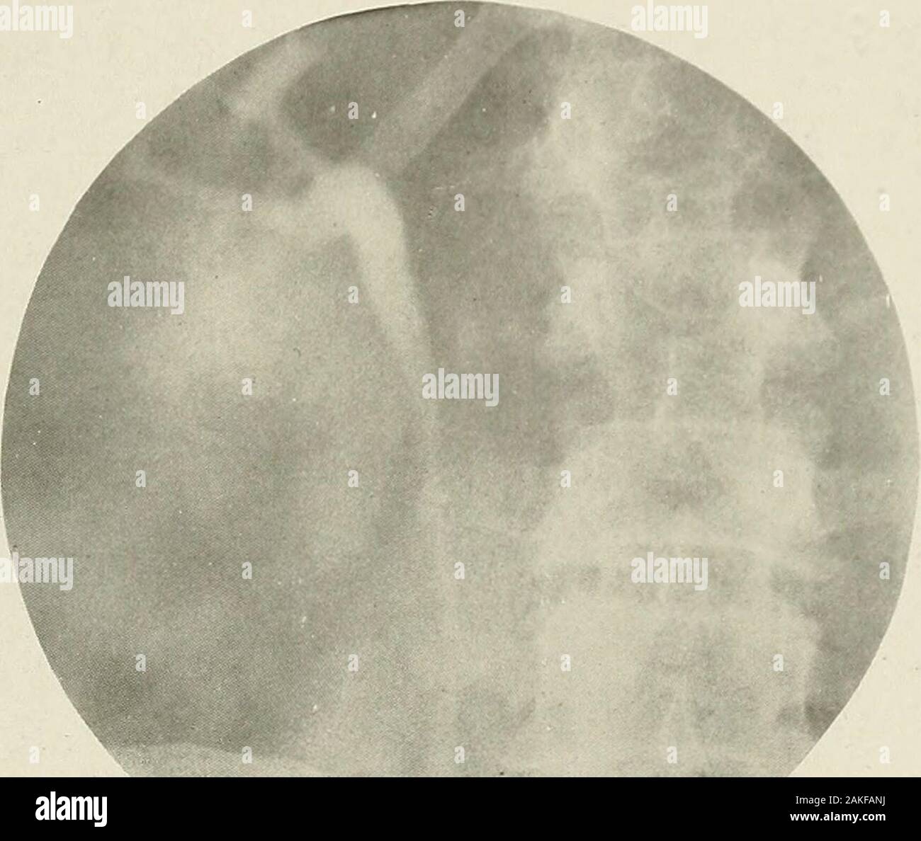 Pyelography (pyelo-ureterography) a study of the normal and pathologic ...