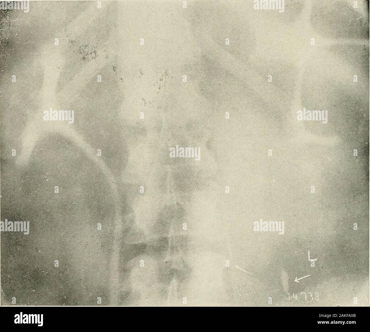 Pyelography (pyelo-ureterography) a study of the normal and pathologic ...