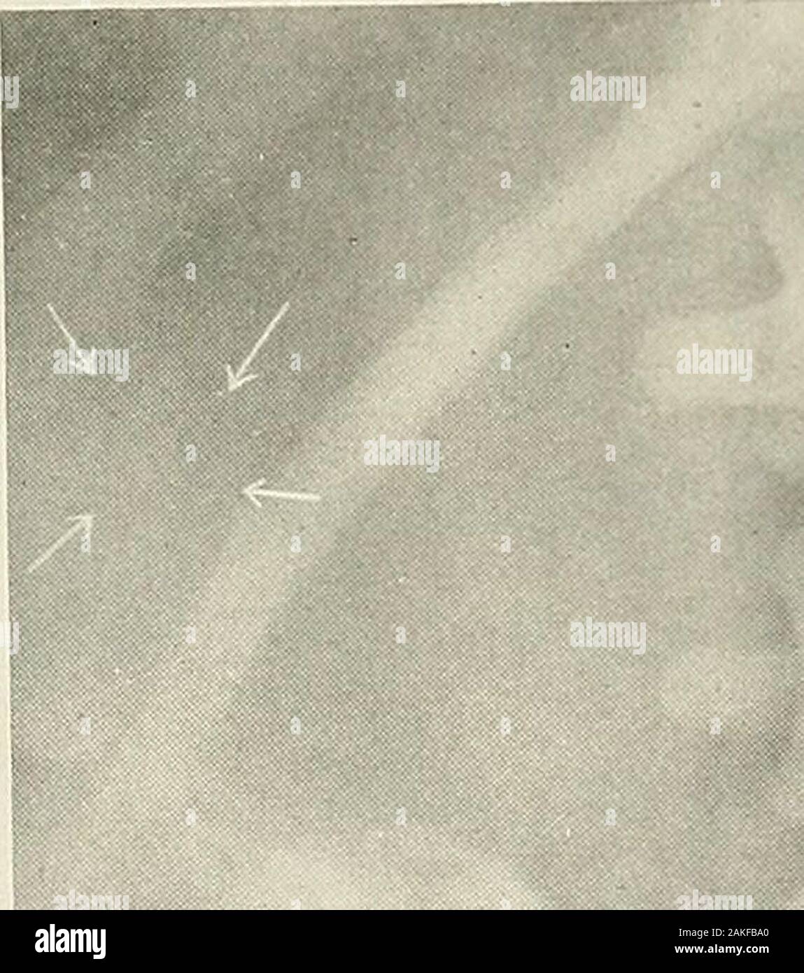 Pyelography (pyelo-ureterography) a study of the normal and pathologic ...