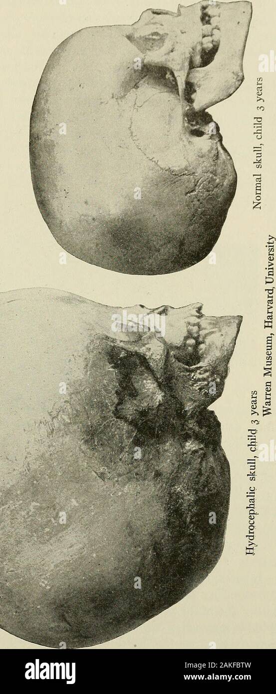 Congenital hydrocephalus hi-res stock photography and images - Alamy