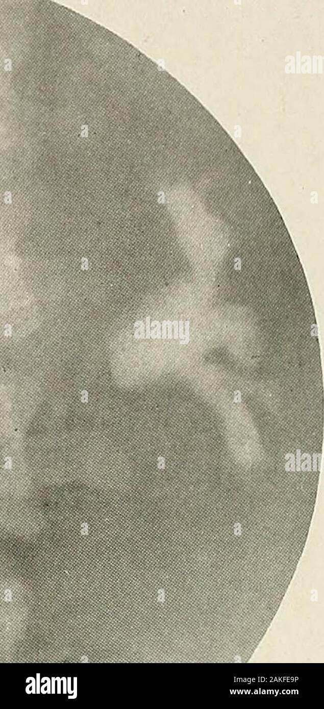 Pyelography (pyelo-ureterography) a study of the normal and pathologic ...