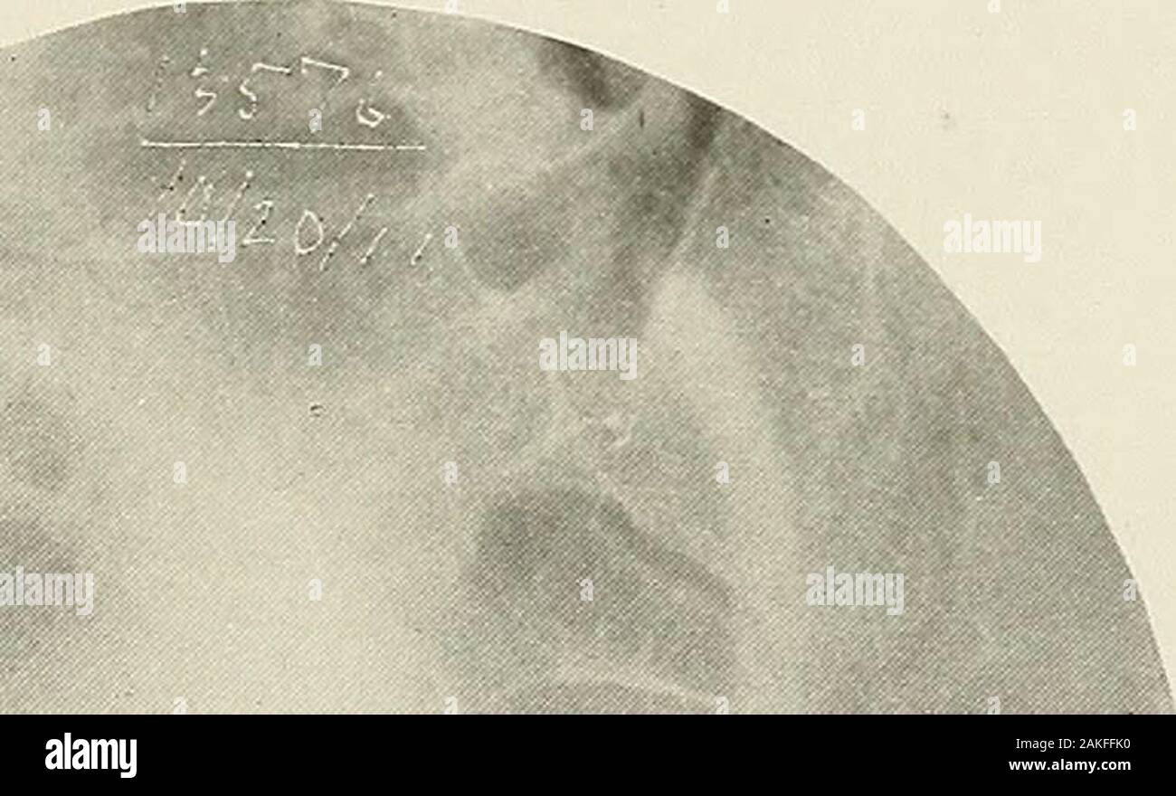 Pyelography (pyelo-ureterography) a study of the normal and pathologic ...