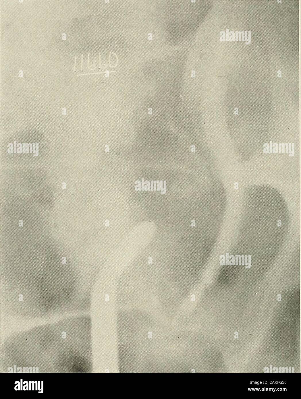 Pyelography (pyelo-ureterography) a study of the normal and pathologic ...