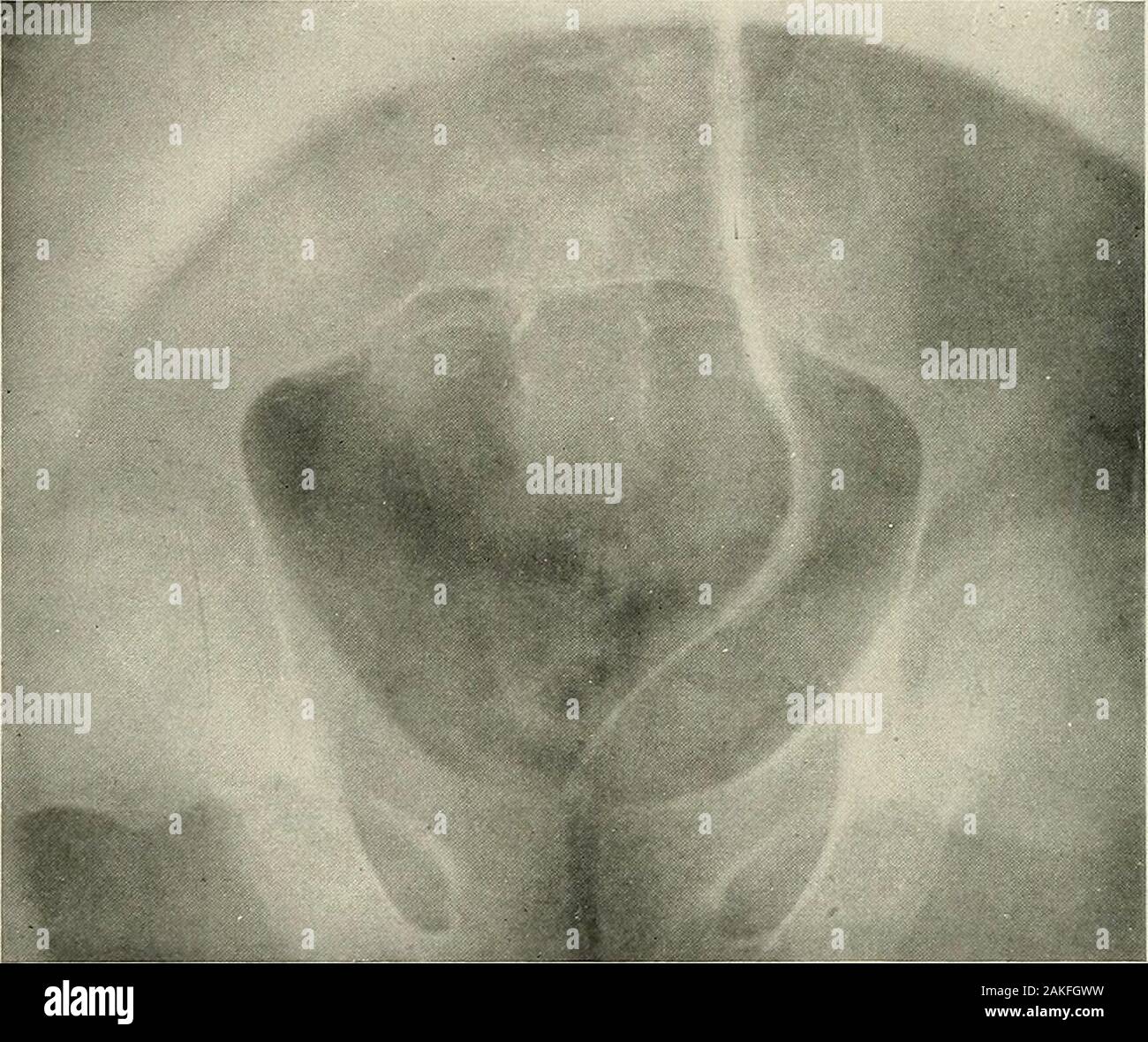 Pyelography (pyelo-ureterography) a study of the normal and pathologic ...